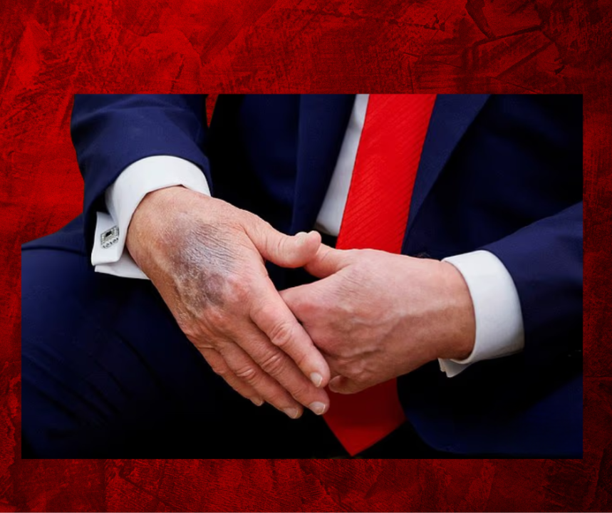 Photos Show Trump With New Bruise on Left Hand as White House Offers ...